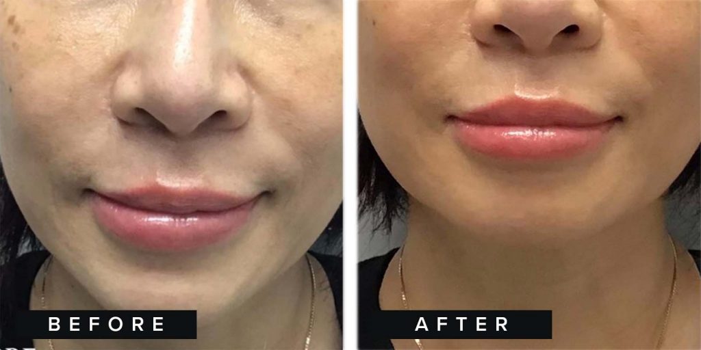 Dermal Fillers Gallery - BotoxRN