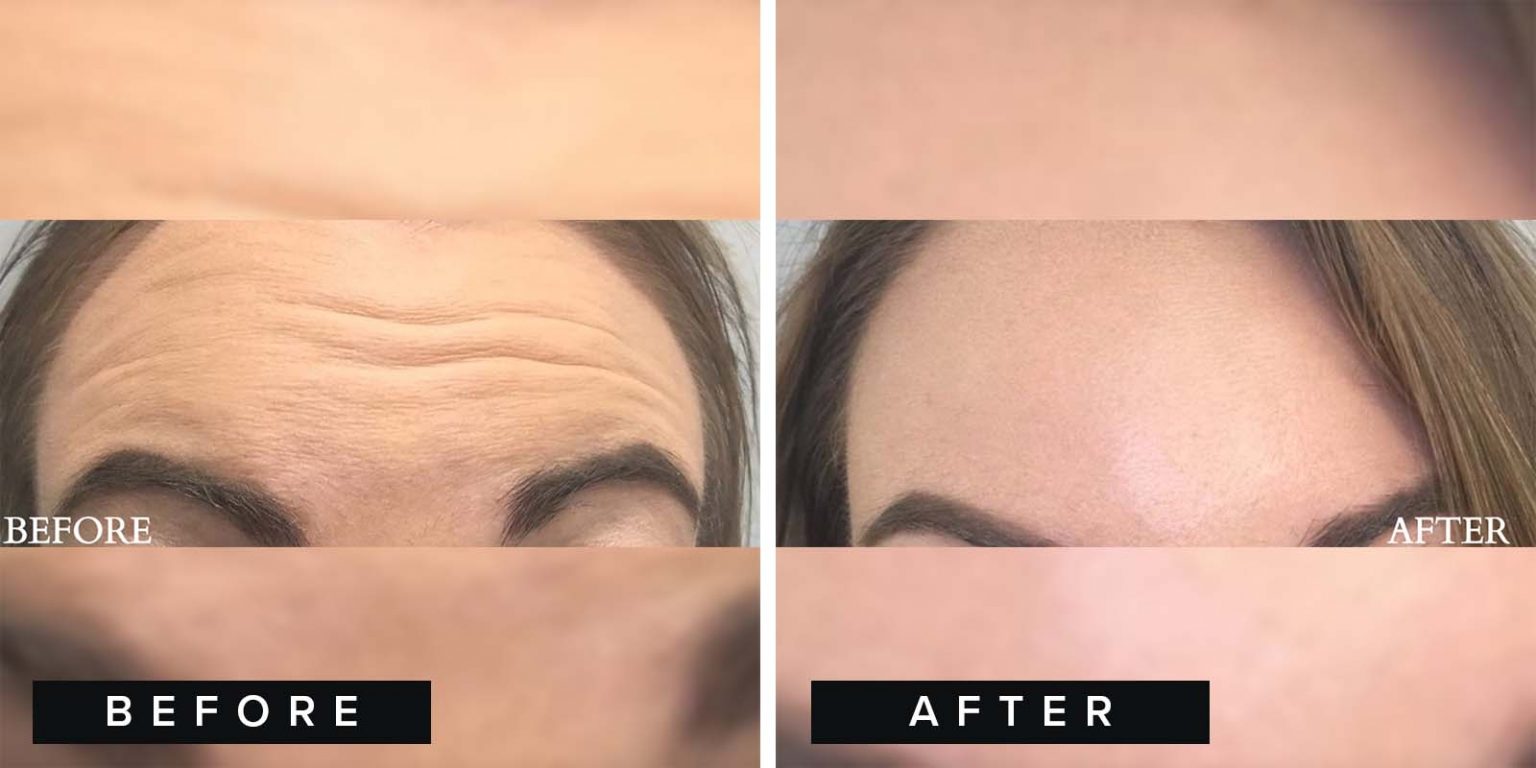 Neurotoxin Gallery - BotoxRN